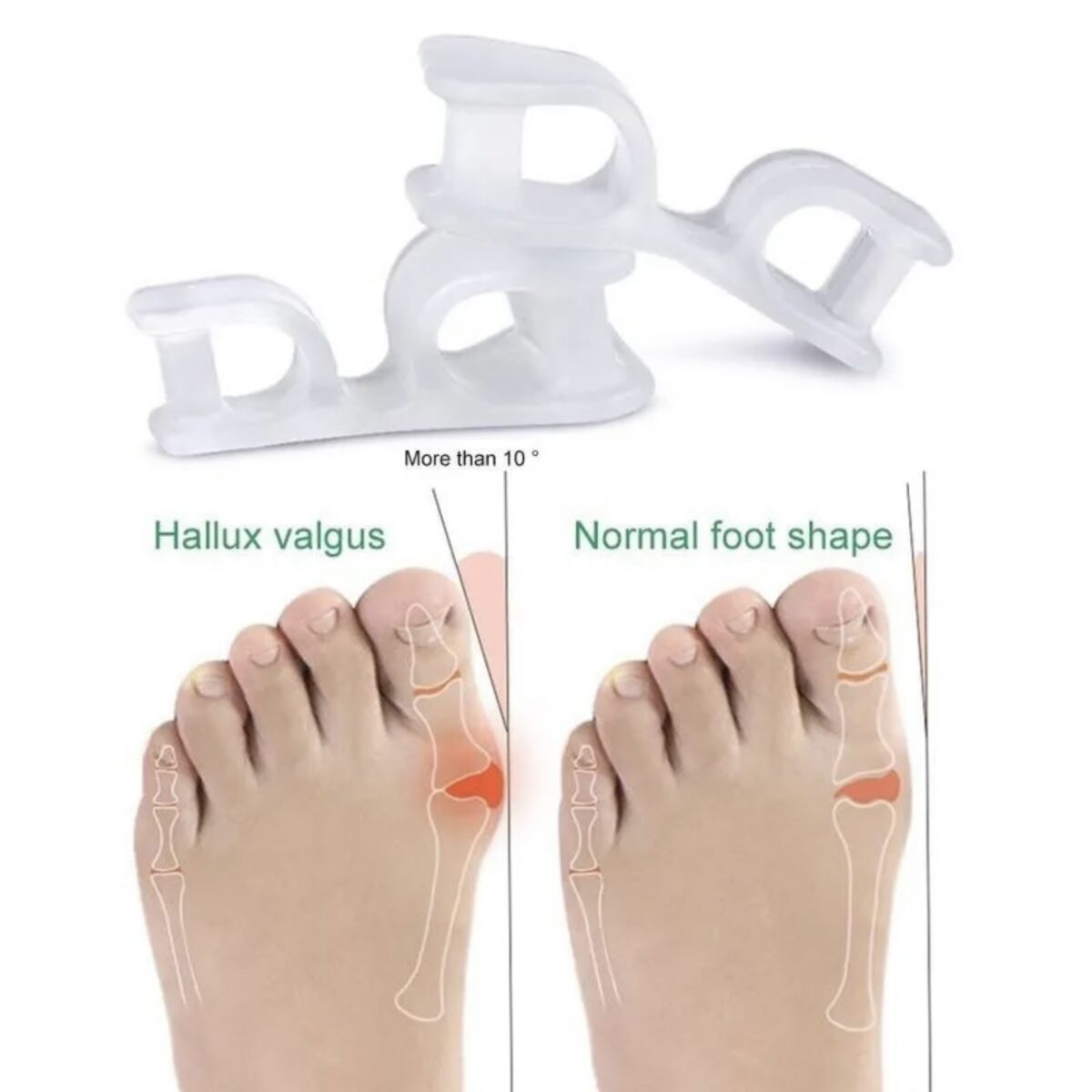 Tenenspreider voor hallux valgus en hamertenen – Regina's Voetensalon